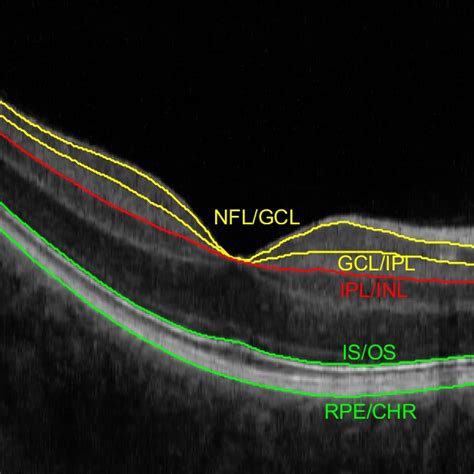 illustrates an example of an acquired oct b scan image with manual