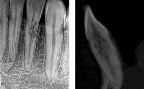 Conservative Endodontic Treatment For Cervical Invasive Resorption