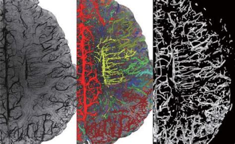 7t Swi Venography 3d High Resolution Swi Mip I M A G E L E F T C