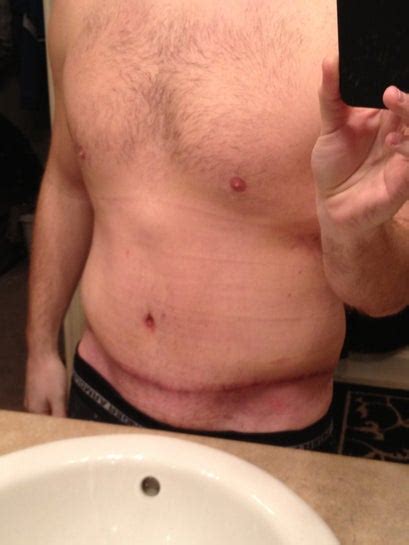 Xiphoid Process Protrusion