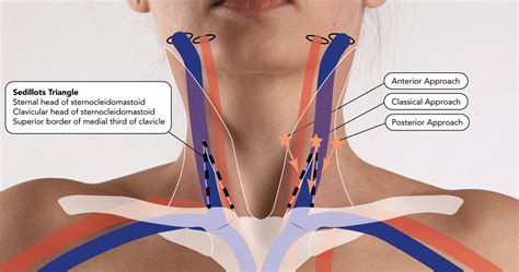 External Jugular Catheter Insertion Cpt Code At Jackie Proctor Blog