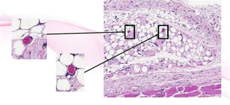 Renuva® Adipose Matrix Injectable Treatment At Estrella Aesthetics