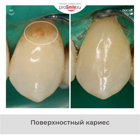 Лечение кариеса в Москве. Пломбы на зуб - стоматология Просмайл.Ру
