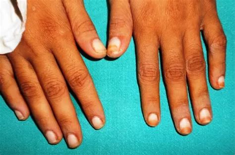 4 Ways Hiv May Affect Your Nails Myhivteam