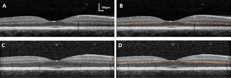 A A Horizontal Sdoct Image Without Segmentation Lines For A Young