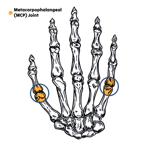 What Is Mcp Joint Arthritis Uk