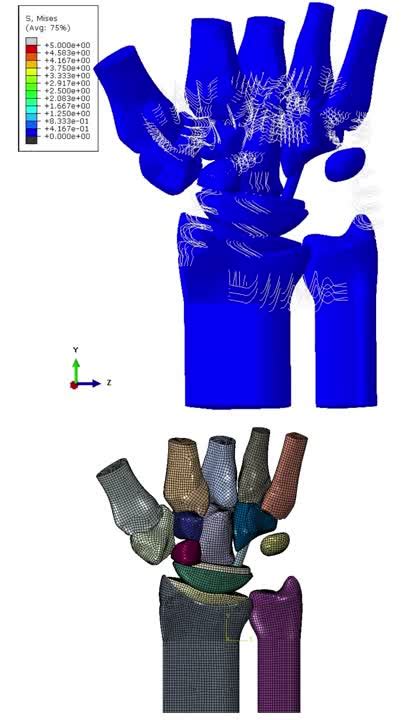 Hyperlyceum On Linkedin Stress Analysis Of Wrist Implant In Abaqus