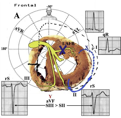 Topic Left Anterior Fascicular Block 12 Lead Ecg Certification