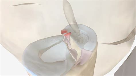 Meniscal Root Tears Are Less Common Than Meniscal Body Tears And Frequently Go Undetected Stock