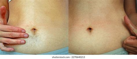 1257 Afbeeldingen Voor Waxing Belly Afbeeldingen Stockfoto‘s En