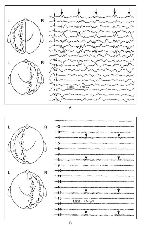Periodic Lateralized Epileptiform Discharges Nejm
