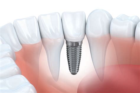 Dentist Marietta West Cobb Periodontics And Implant Dentistry