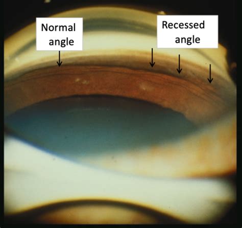 Gonioscopy Anatomy