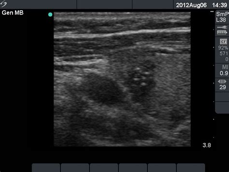 Selected Topics Intranodular Hyperechogenic Figures
