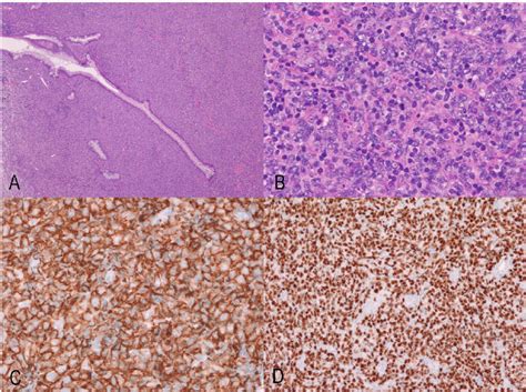 Diffuse Large B Cell Lymphoma Of The Cervix A Diffuse In Fi Ltration Download Scientific