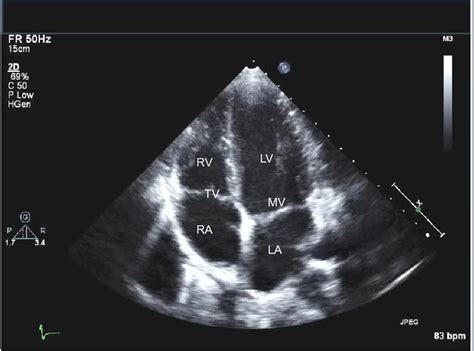 Echocardiogram Echo Dysautonomia Mvp Center Paula Moore M D