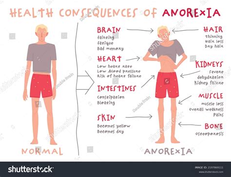 Anorexia Nervosa
