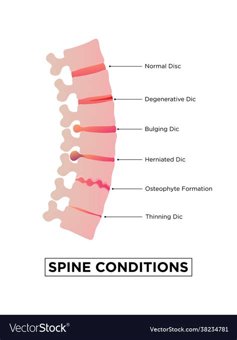 Stages Spinal Osteochondrosis Royalty Free Vector Image