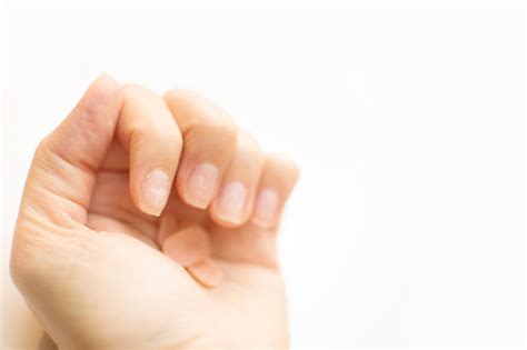 흰색 배경에 나쁜 매니큐어 후 여자 손톱을 닫습니다 자란 표피 손톱과 오염 된 네일 플레이트 흐리게 손톱을 자랐습니다 젤 매니큐어가 떨어졌다 공간을 복사합니다 건강 하고