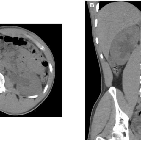 Left Retrograde Pyelogram Revealing Stenosis Of The Left Distal Ureter