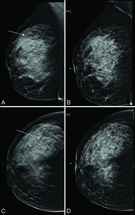 Positive Predictive Value Of Tomosynthesis Guided Biopsies Of