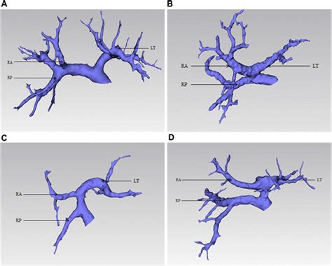 Cholangiocarcinoma Type