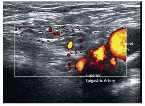 Ultrasound Guided Genitofemoral Nerve Block Anesthesia Key