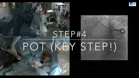 Crush Stenting Pci Youtube