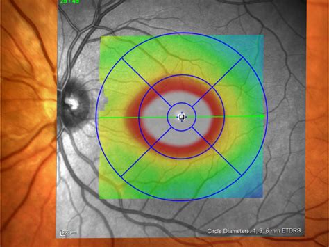 Rcs I Navigierte Netzhaut Lasertherapie
