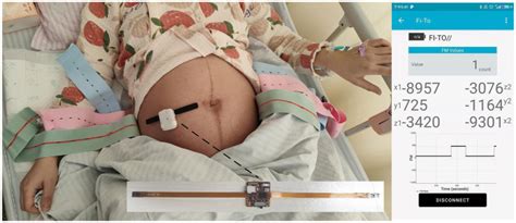 A Wearable Fetal Movement Detection System For Pregnant Women Pmc