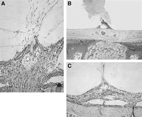 Photomicrographs Show Neovascularization Of The Disk Nvd Arising From