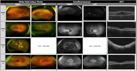 Diagnostic Ophthalmic Imaging For Cases 1 4 With Optos Ultra Widefield