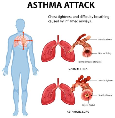 Free Vector Understanding Asthma And Lung Function