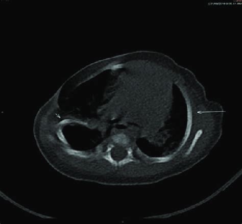 Axial Ct Image Shows The Normal Left Rib Long Arrow The Download Scientific Diagram