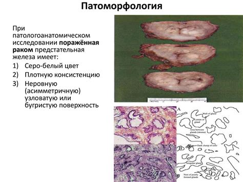 Рак предстательной железы презентация онлайн