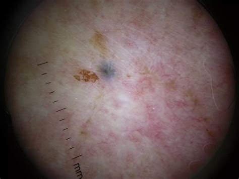 Annular Lesion On The Breast Ppt