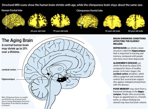 Shrinkage Of Cerebellum
