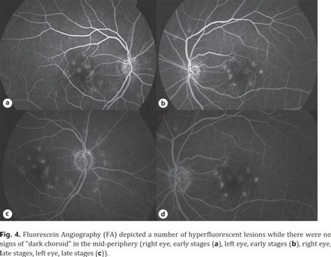 Multifocal Pattern Dystrophy Simulating Fundus Flavimaculatus