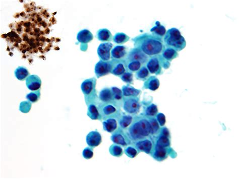 Urinary Tract Cytopathology Surgical Pathology Clinics