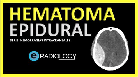 TomografÍa De CrÁneo Y Hematoma Epidural Lo Que Debes Saber Para Un