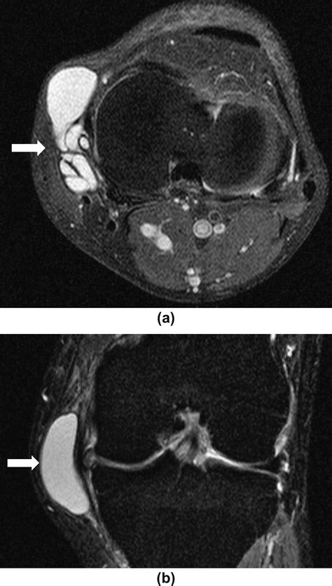 Ultrasound Guided Percutaneous Drainage Of Meniscal Cysts Preliminary