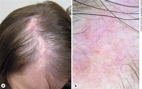 Trichoscopic Features Of Linear Morphea On The Scalp Pmc