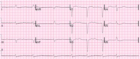 Pre Existing Left Bundle Branch Block And Atrial Fib What Is Alarming On This Routine Pre