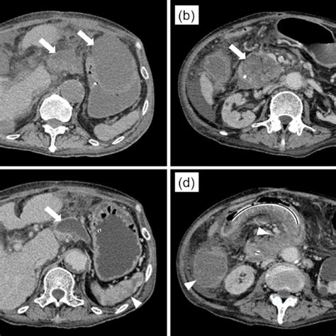 Figure3 Images Of Abdominal CT During The Course In Our Hospital A Download Scientific
