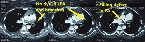 Ctpa Showing Filling Defect In Pulmonary Artery Download Scientific Diagram