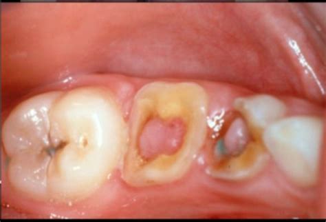 Chronic Hyperplastic Pulpitis