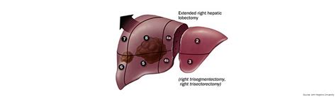Liver Metastases Bowel Cancer Treatment