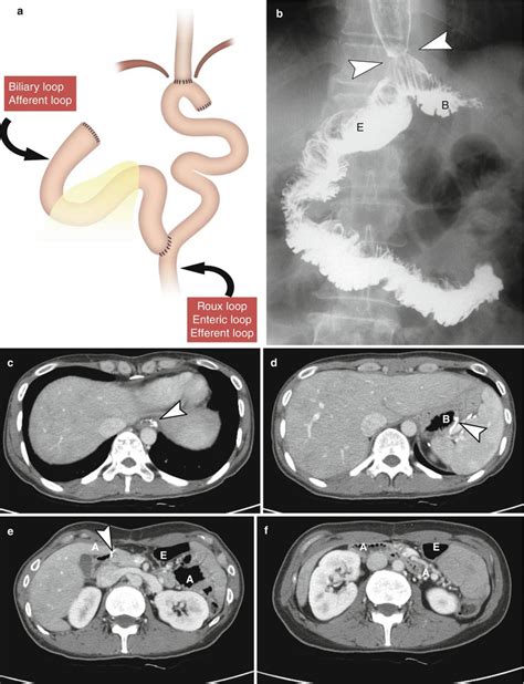 Total Gastrectomy Anatomy