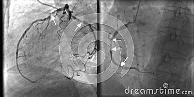 Multivessel Coronary Disease On Angiography Stock Photo Image 61873622