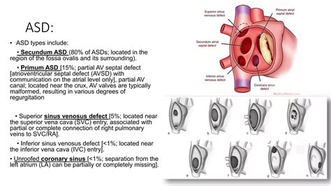 Atrial Septal Defects Ventricular Septal Defects Assessmentinvestigations And Managemnet Asd